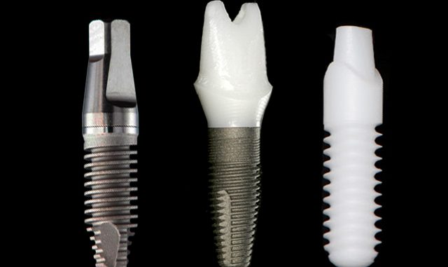 Titanium Implants